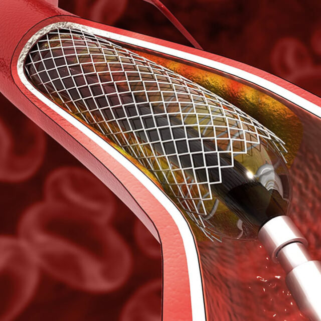 Percutaneous Coronary Intervention (PCI) | Bangkok Heart Hospital